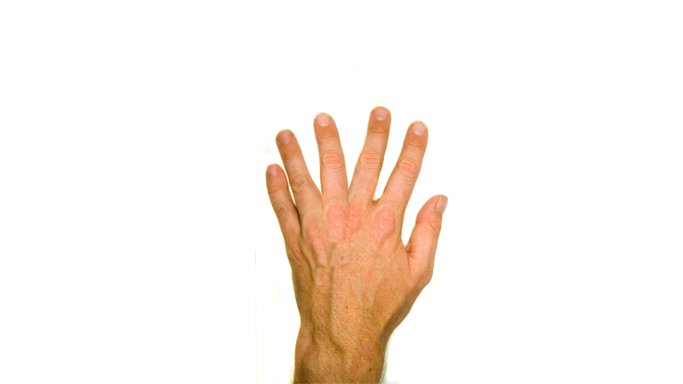 New Mexico: Menschen mit sechs Fingern waren die tollsten · Dlf Nova